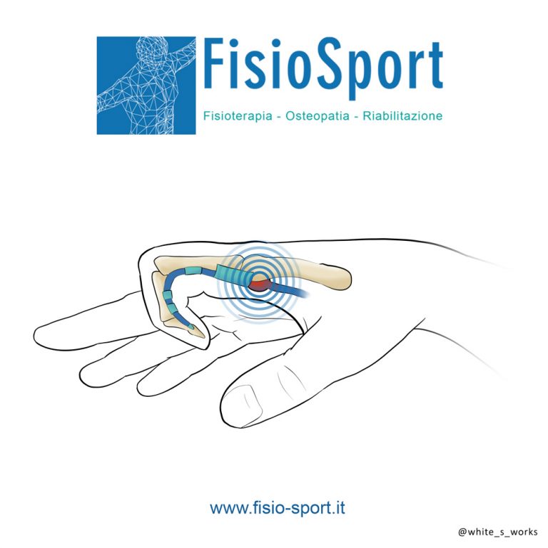 Dito a scatto | FisioSport